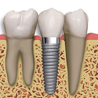 Best Clinic for Dental Implant Surgery in India, Ludhiana